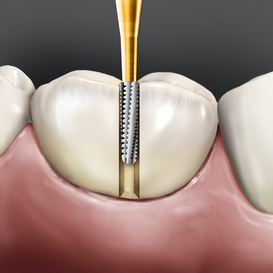 Endo Access Bur Set – E3Endo
