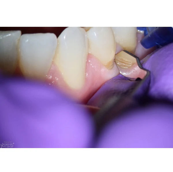Carr Surgical Micromirrors - Mirror – E3Endo