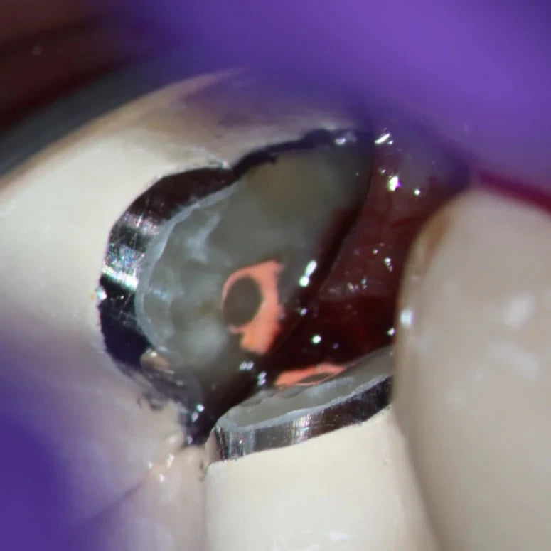 SAPPHIRE HD Dental PHOTOGRAPHY MIRRORS – E3Endo