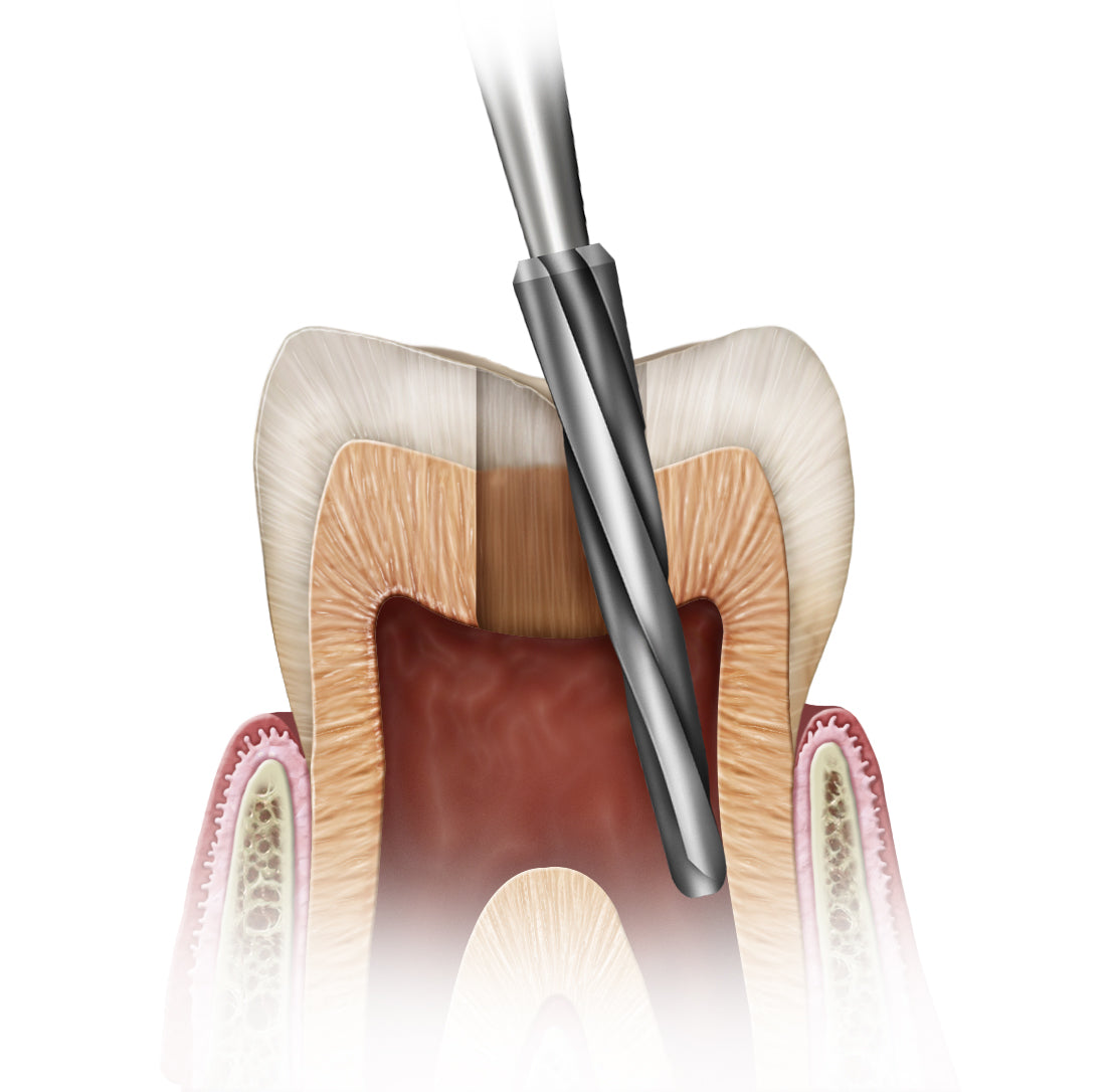 SS White Safe End Endodontic Access Bur – E3Endo